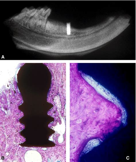 A Radiograph Of A Metallic Implant In The Posttooth‐extraction Socket