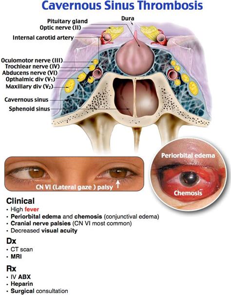 Causes Of Cavernous Sinus Thrombosis