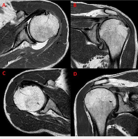 Bilateral Shoulder Mri Showing Irreparable Rotator Cuff Tear On Axial Download Scientific