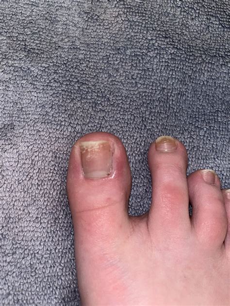 3 Days Post Op Partial Nail Removal Ringrowntoenails