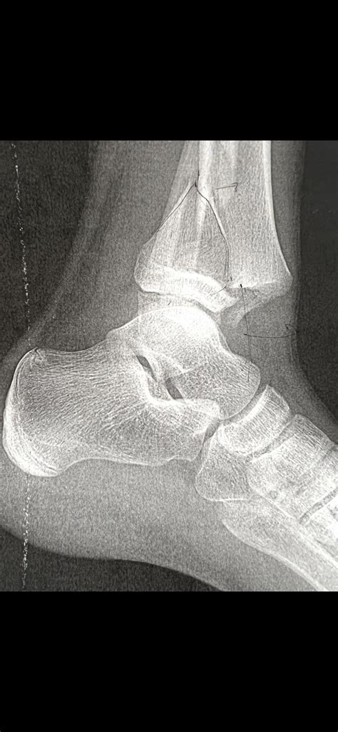 Guess How Tibia Fibula Dislocation R Xrayporn