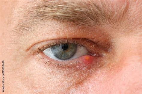 Fotografia Do Stock Close Up Mans Eye With Stye Symptoms Stye Hordeolum Disease On Eye Of A
