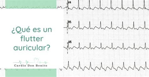 Qué es un flutter auricular En qué se parece a la fibrilación auricular