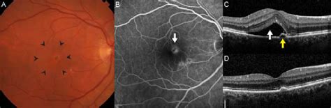 Choroidal Neovascularization Is The Hallmark Of Neovascular Age Related Download Scientific