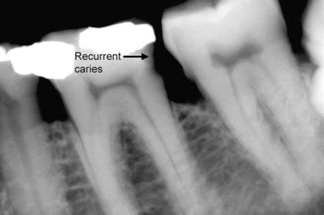 Recurrent Caries
