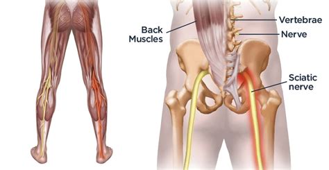 7 Poses To Soothe Sciatica Yoga International