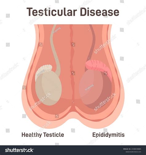 Epididymitis Inflammation Coiled Tube Back Testicle Stock Vector