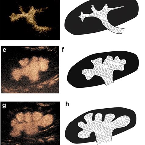 Grading Vesicoureteral Reflux Vur On Contrast Enhanced Voiding Download Scientific Diagram