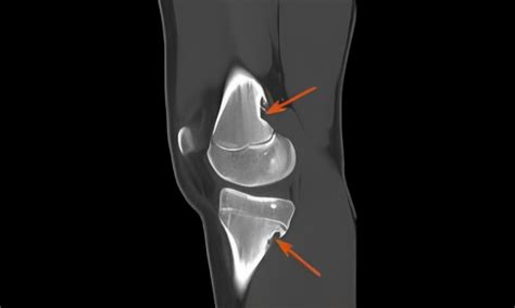 Ct Scans For Knee Injuries Ct Scans For Knee Injuries