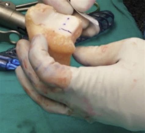Frozen Distal Tibia Allograft Is Used As The Donor Graft Download