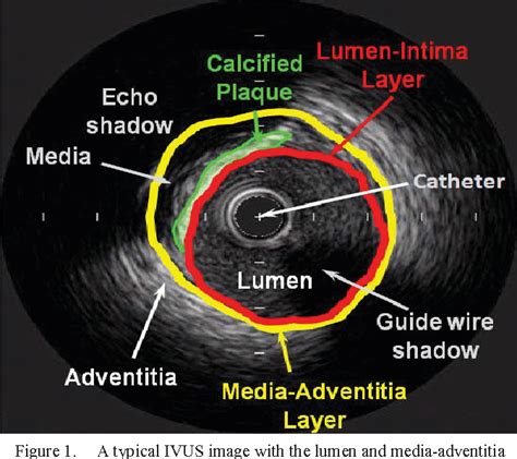 Figure 1 From Automatic Soft And Hard Plaque Detection In Ivus Images