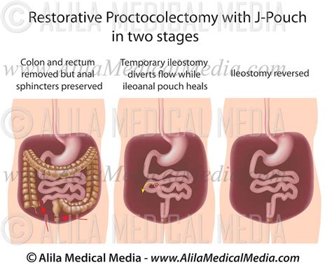 Facts About J Pouch Procedures Iqgp