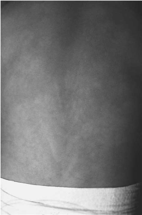 Hyperpigmented Macules And Patches In A Whorled Distribution Pattern Hyperpigmented Macules And Patches In A Whorled Distribution Pattern