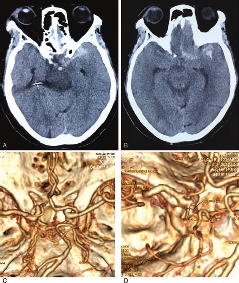 CT Scan And CTA Of The Patient Before The Procedure A B Head CT Scan Download Scientific