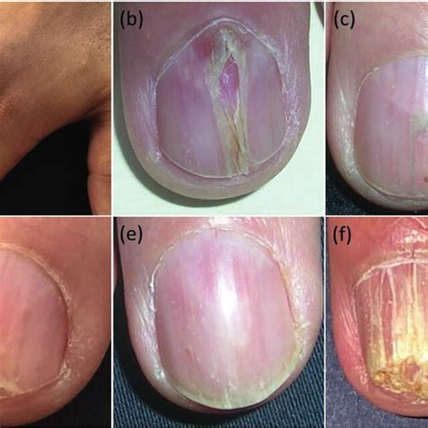 A A Subcutaneous Nodule On The Dorsum Of The Right Hand B A Download Scientific Diagram