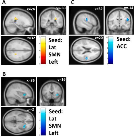 Functional Connectivity Fc Showed A Significant Difference Between