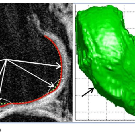 Osteophyte Delineation And 3d Volumetric Representation A Automatic