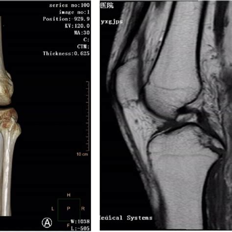 Evaluation Of The Displacement And Configuration Of An Avulsion Download Scientific Diagram