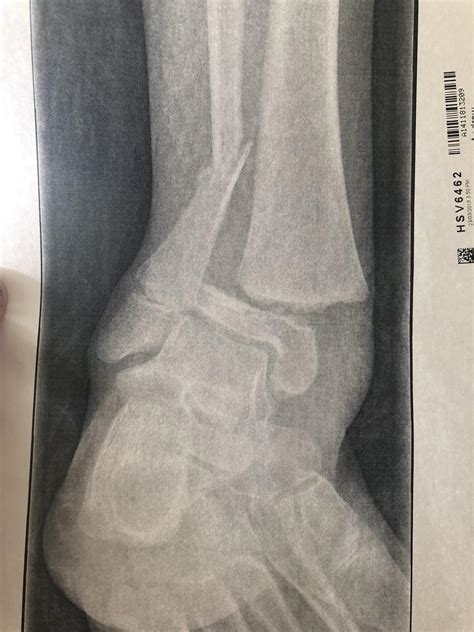 Tib Fib And Ankle All Snapped R Brokeabone