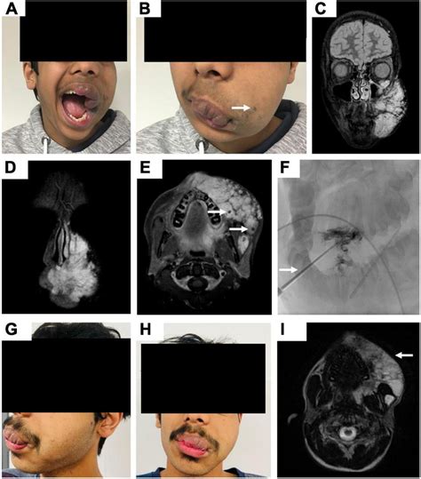 Fourteen Year Old Male Patient With A Venous Malformation Vm