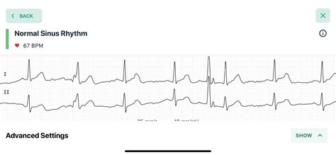 Possible Afib R Cardiophobias
