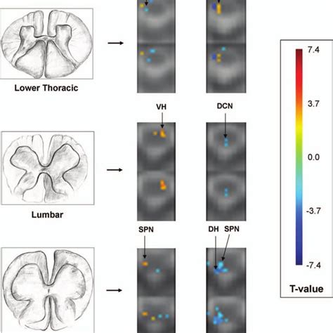 Summary Of Signal Intensity Changes In The Spinal Cord During Download Table