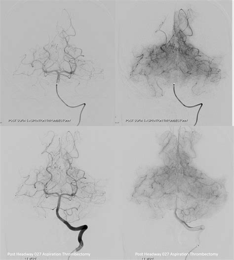 Pca Stroke Caution — Parallel Universe Pca Impostors — Circumflex And