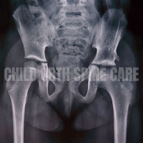 Expert Pediatric Orthopedic Surgeon Congenital Hip Dislocation
