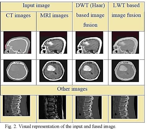 Figure From Establishment Of An Effective Brain Tumor Classification System Through Image