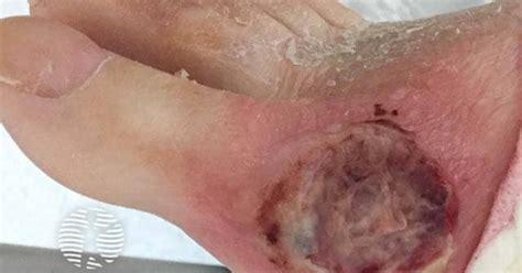 Pyoderma Gangrenosum Image