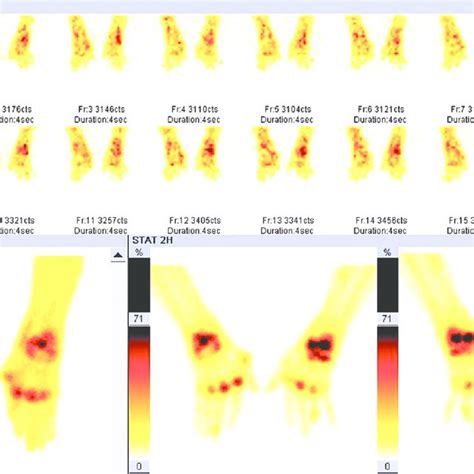 Rs Of The Elbow Joint Under Fluoroscopic Guidance Contrast Medium Is