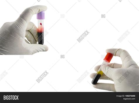 選択した画像 edta blood sample test 300993 Edta blood sample test Freepnggejpmlxj