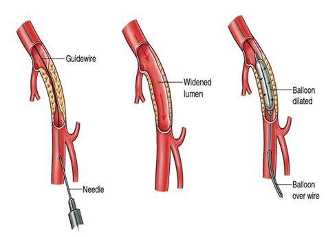 Procedure Of Coronary Angioplasty DocOPD