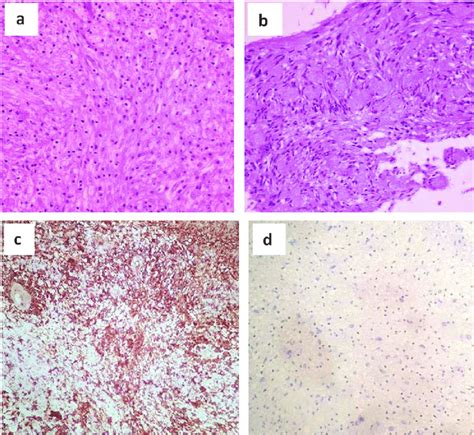 A Histopathology Showing A Biphasic Tumor With Predominantly Download Scientific Diagram