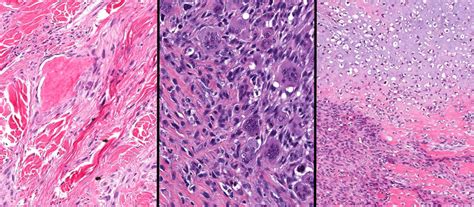Primary Cutaneous Extraskeletal Osteosarcoma A Series Of 16 Cases Pathology