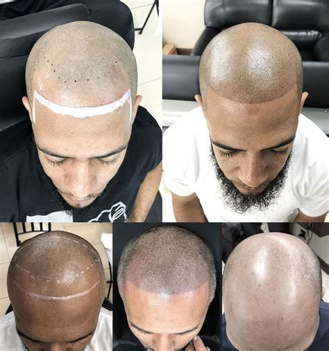 Scalp Micro Pigmentation Services In Broward County Doublecrosstattoo Scalp Micro Pigmentation Services In Broward County Doublecrosstattoo