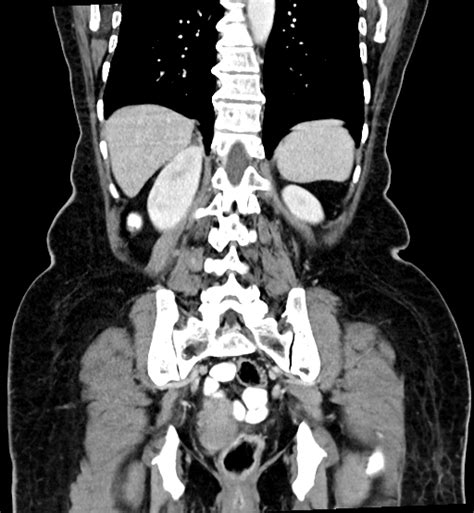 Filepancreatic Adenocarcinoma Double Duct Sign Liver And Cystic
