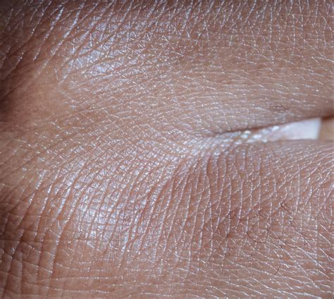 Take Christmas Tree Rash Seriously Doctors Explain How It Could Be Sign Of A Respiratory