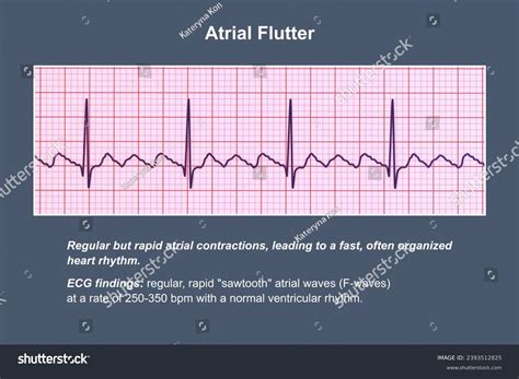 Ecg Atrial Flutter Abnormal Heart Rhythm Stock Illustration 2393512825 Shutterstock