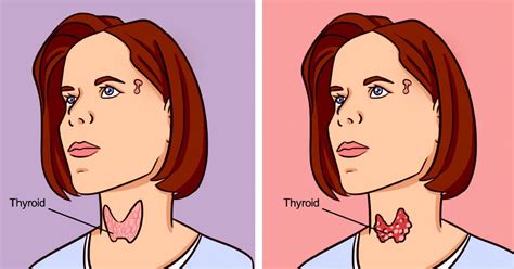 Hypothyroidism Vs Hyperthyroidism