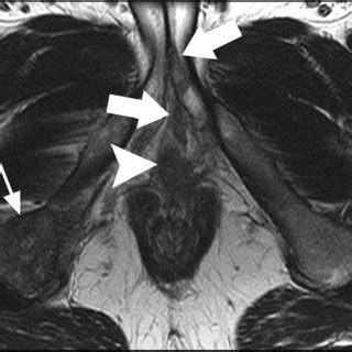 Illustration Showing The Anatomy Of The Urogenital Diaphragm And Its