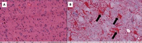 The Assessment Of Reactive Astrocytes Is More Challenging In Diffuse