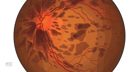 Optic Nerve Eye Hemorrhage At Eula Seay Blog