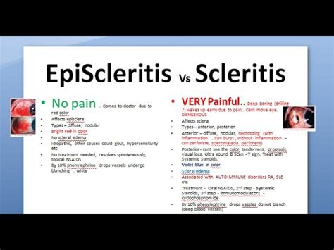 Anterior Diffuse Scleritis Source Redatlas Org