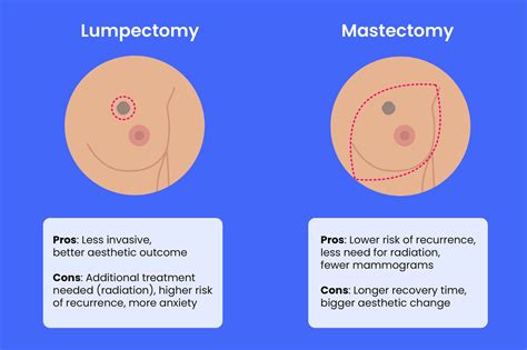 Lumpectomy The Breast Mastectomy Versus Lumpectomy An Important