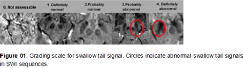Evaluation Of Swallow Tail Sign On 15 Tesla Magnetic Resonance Imaging