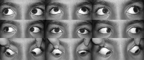 Diplopia After Excessive Smart Phone Usage Pmc