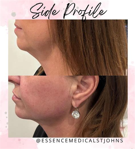 Essence Medical Lipodissolve Deoxycholic Acid Treatment