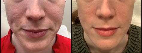 Skin Tightening Microneedling And Rf Microneedling Before And After Mi