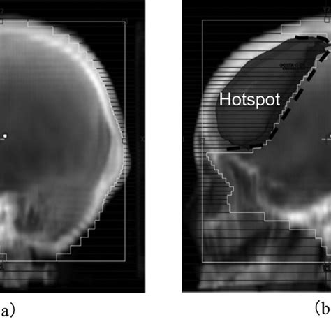 Beams Eye Views Bevs With The Multileaf Collimator Shapes Of The